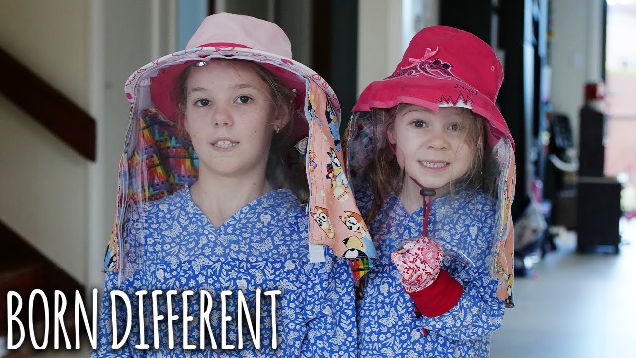 The sisters who can't go out in sunlight - born different