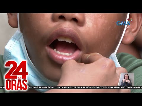 72% ng mga Pinoy, may bulok na ngipin ayon sa PHL Dental Assoc ...